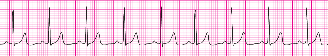 Normal Sinus Rhythm | Time of Care