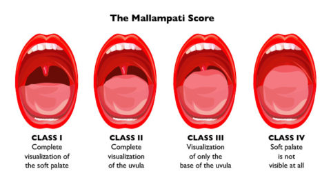 Mallampati Score | Time of Care